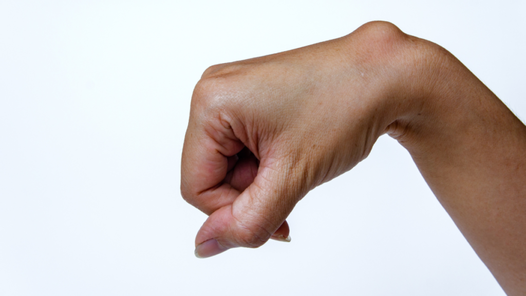 Ganglion Cysts - Georgia